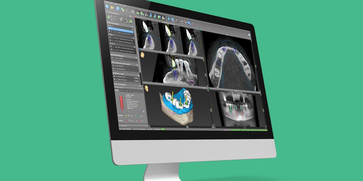 Digital Dental Implant Planning Software | Patient Communication Tools